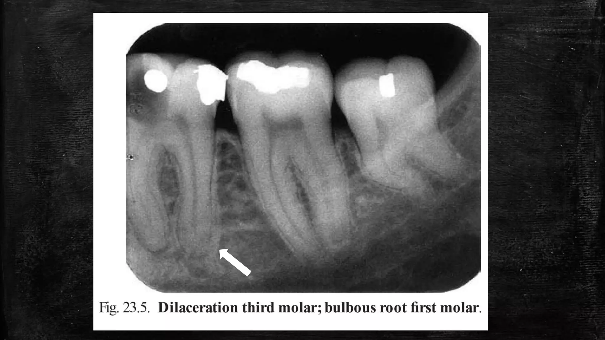 Alterations in tooth morphology | PPTX | Dental Health | Diseases and ...