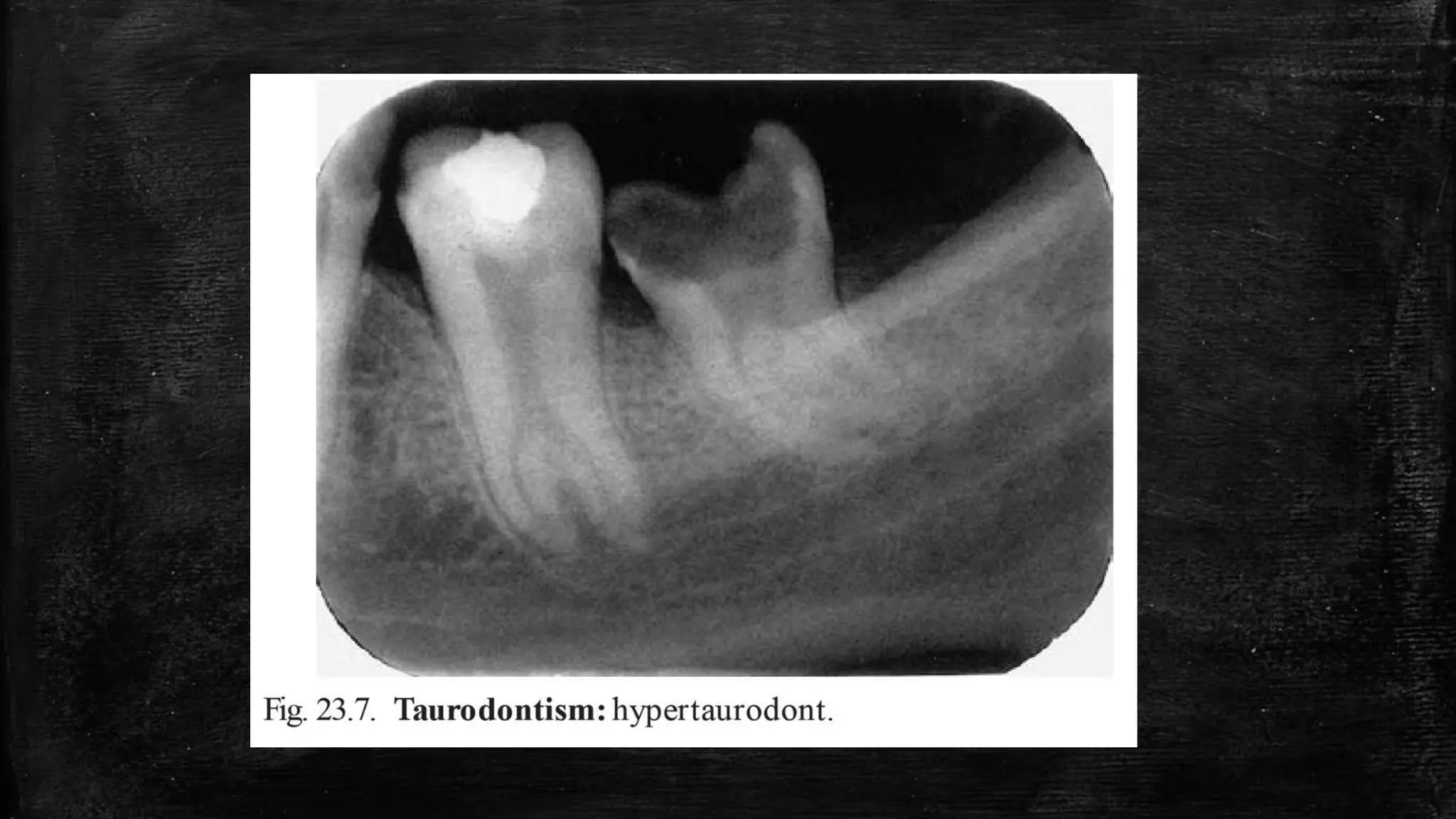 Alterations in tooth morphology | PPTX | Dental Health | Diseases and ...