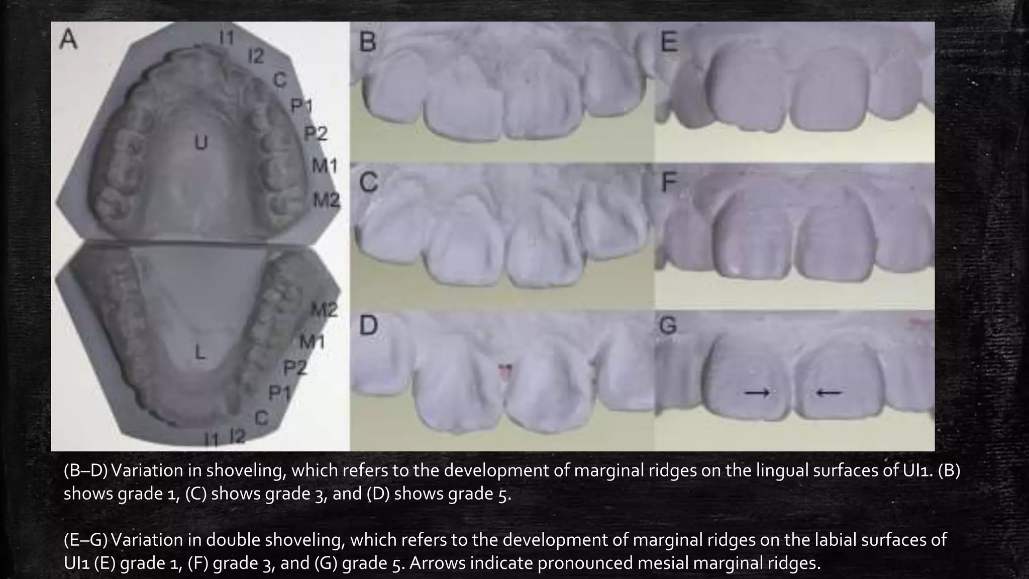 Alterations in tooth morphology | PPTX | Dental Health | Diseases and ...