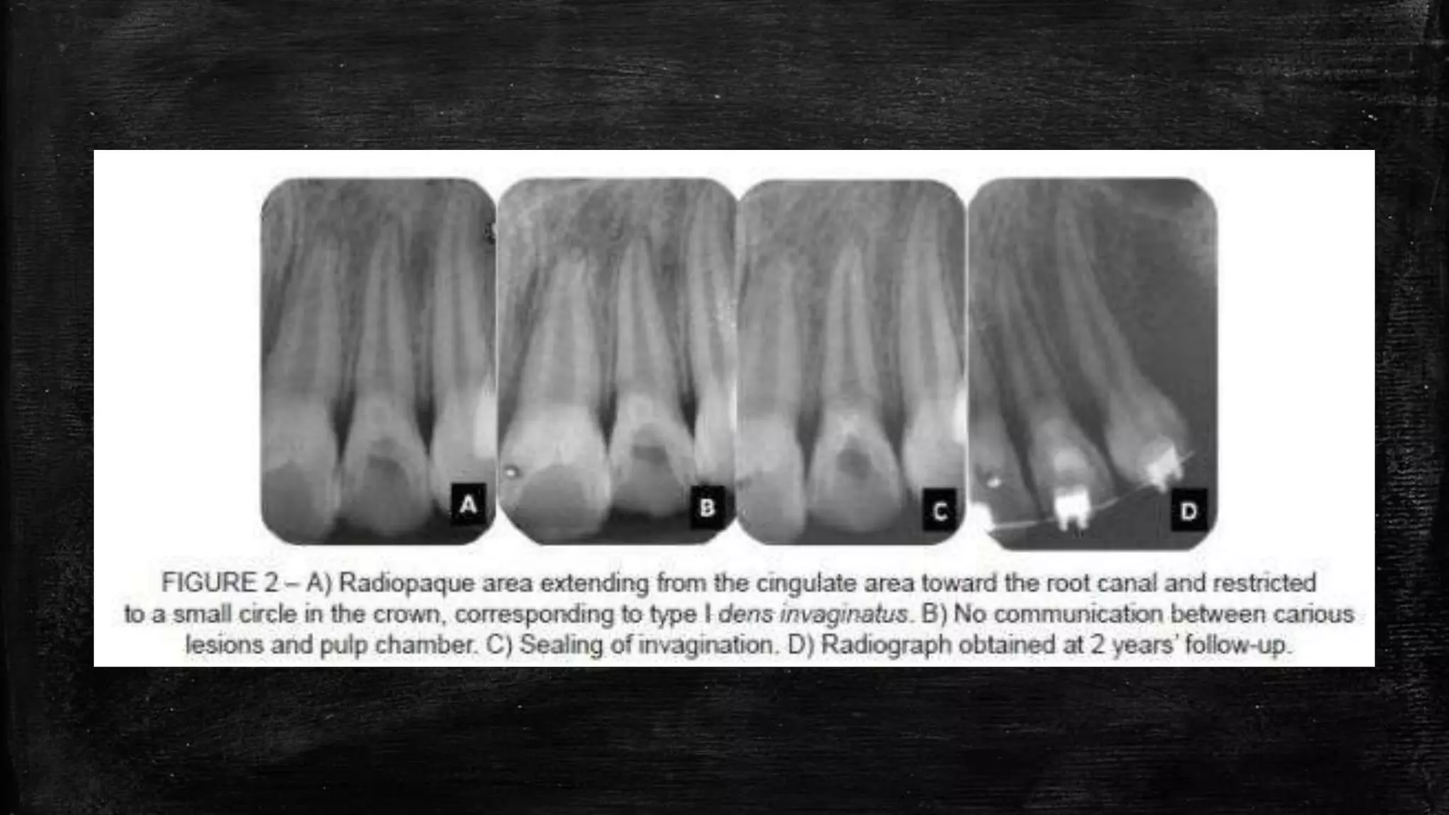 Alterations in tooth morphology | PPTX | Dental Health | Diseases and ...