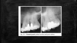 Alterations in tooth morphology | PPTX | Dental Health | Diseases and ...