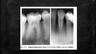 Alterations in tooth morphology | PPTX | Dental Health | Diseases and ...