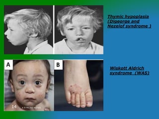 ALTERED ANTIGENS AND IMMUNODEFICIENCIES. | PPTX