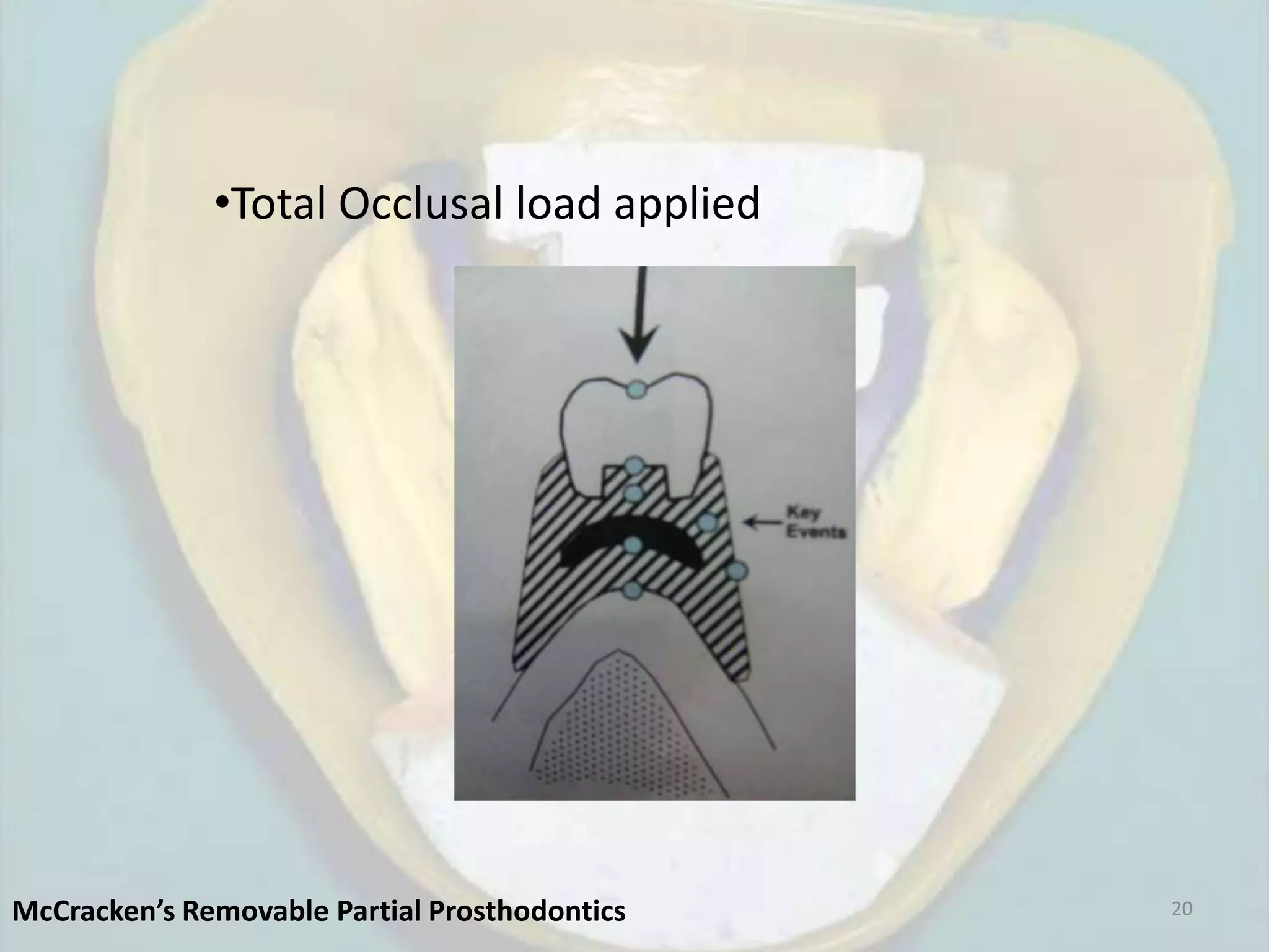 Altered casts technique | PPTX