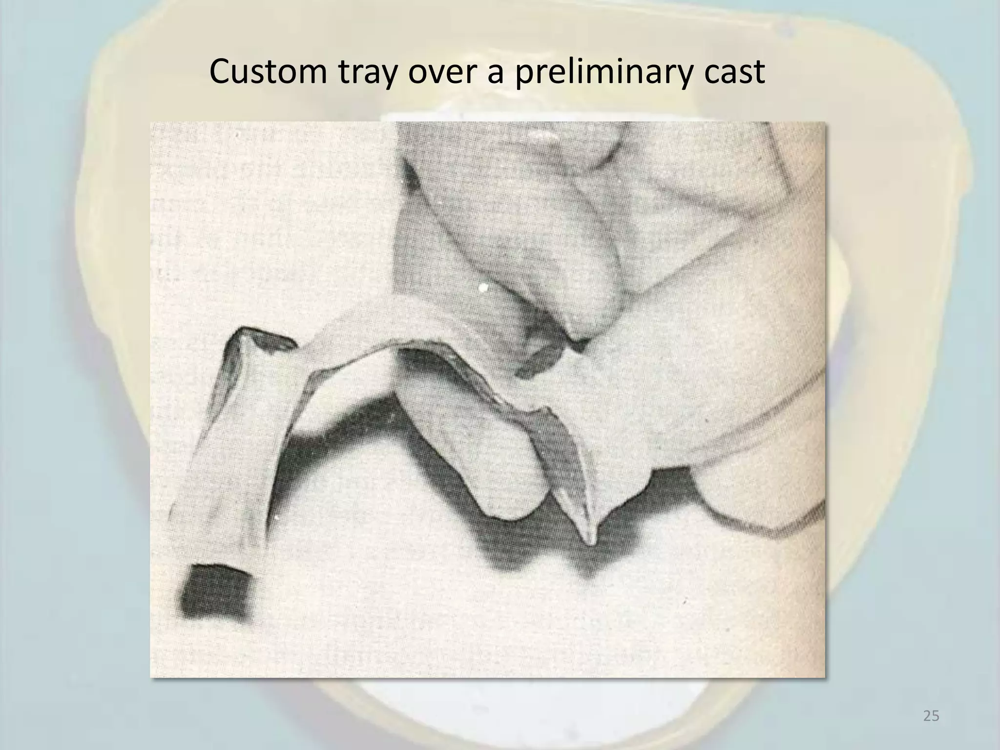 Altered casts technique | PPTX