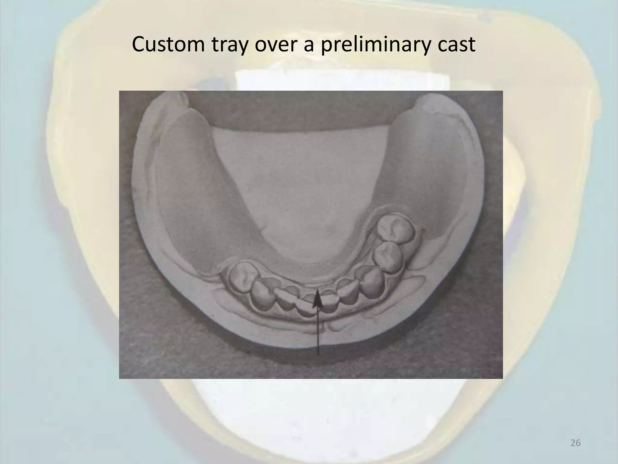 Altered casts technique | PPTX