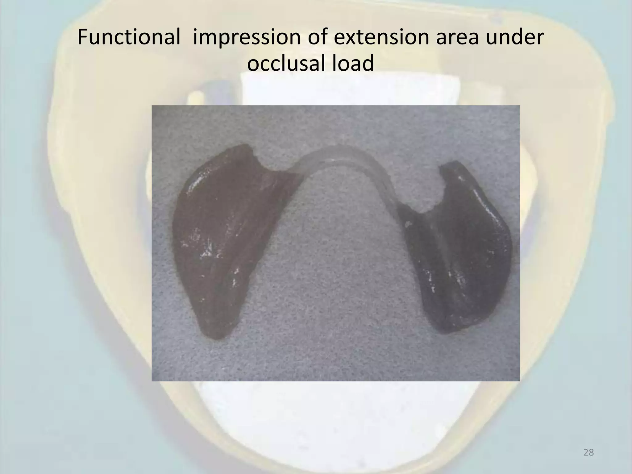 Altered casts technique | PPTX