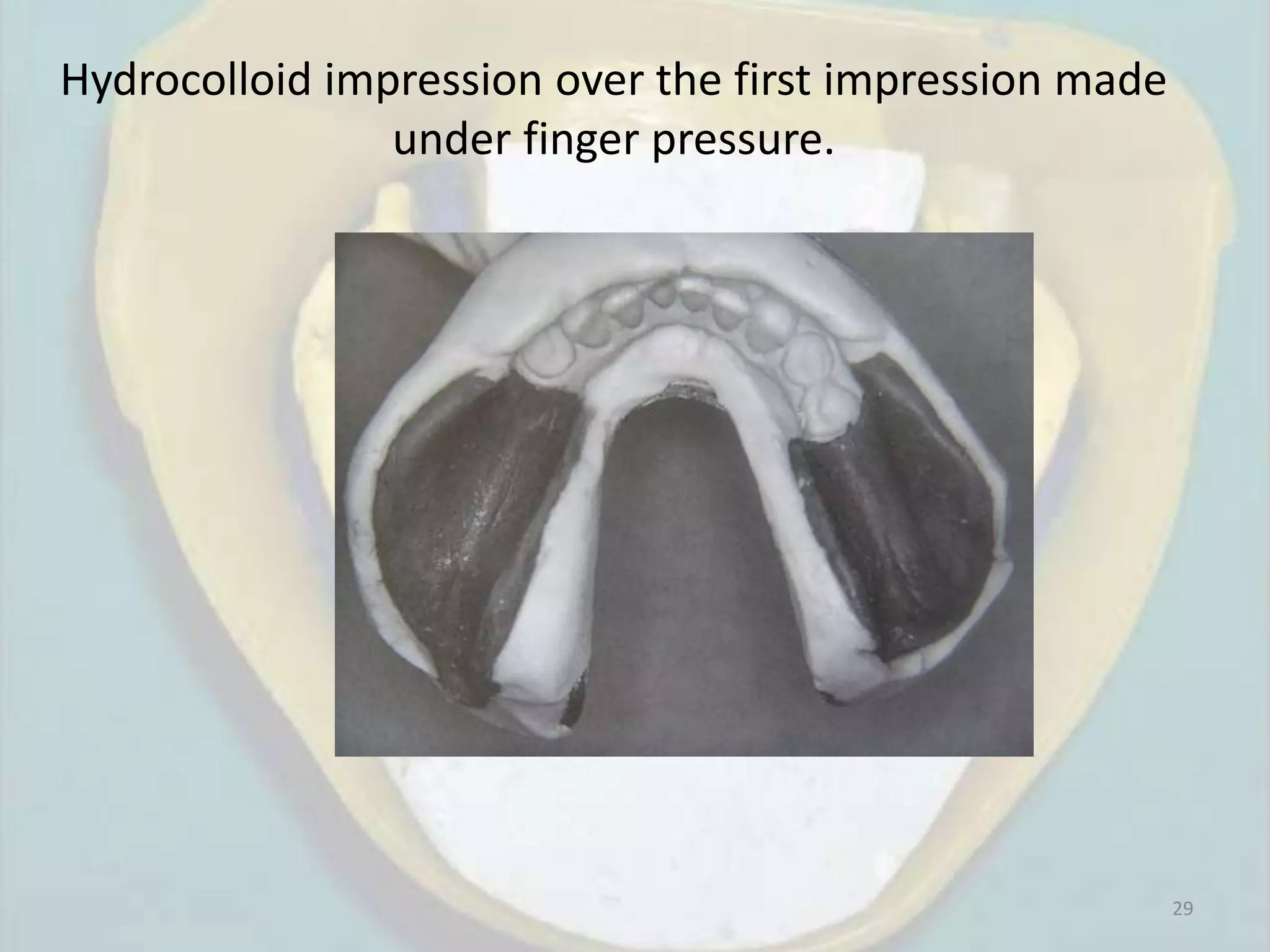 Altered casts technique | PPTX