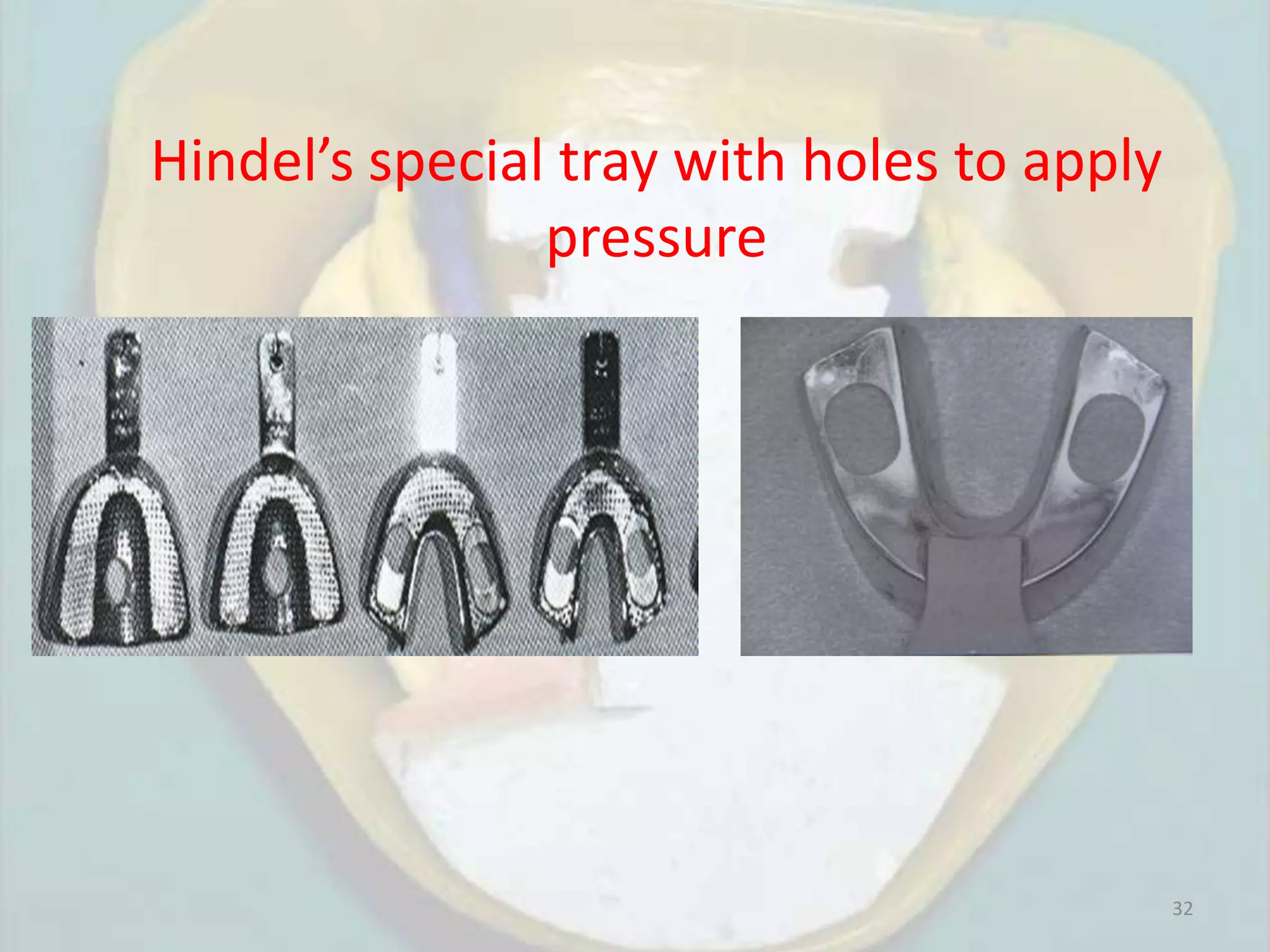 Altered casts technique | PPTX