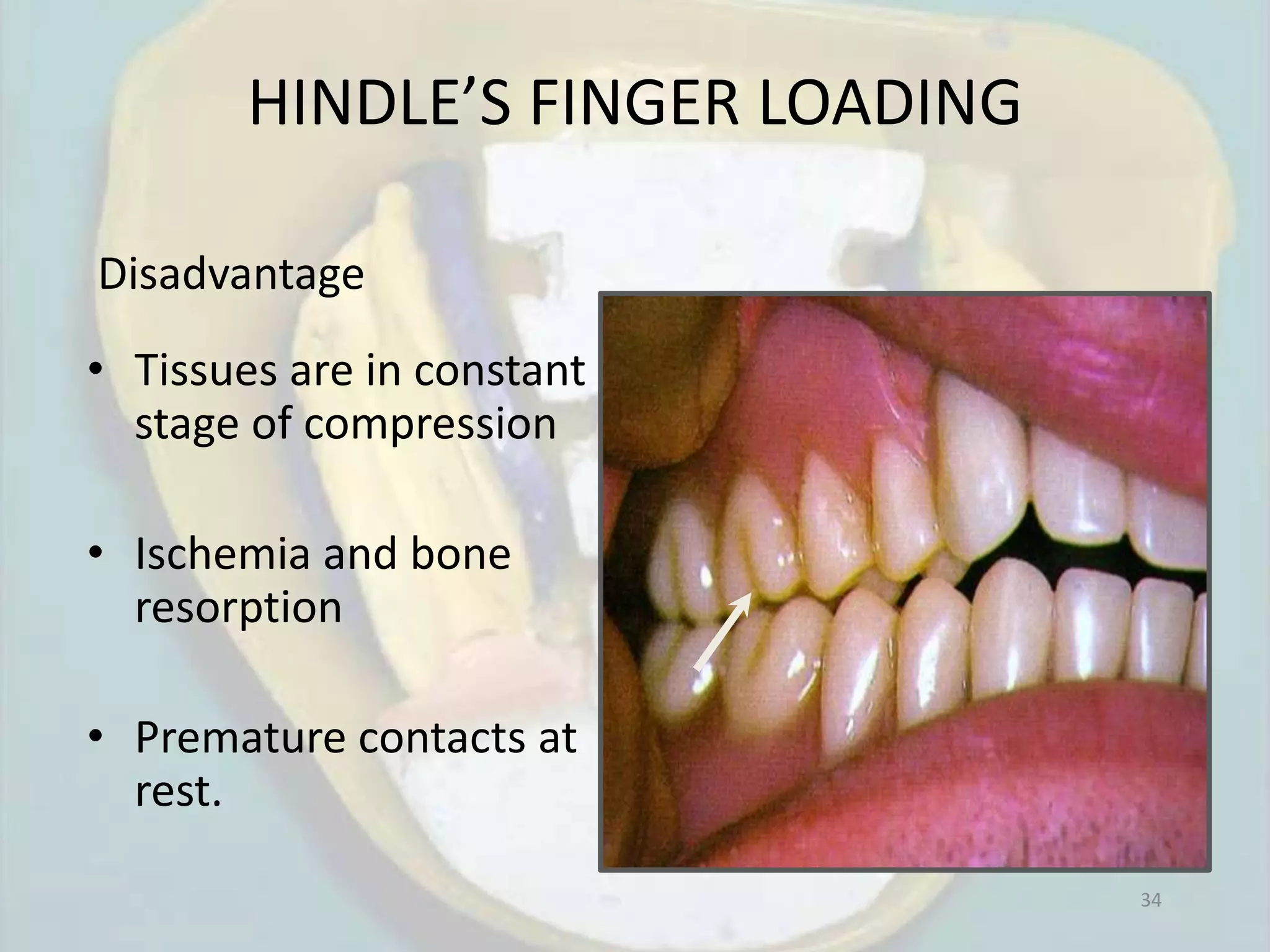 Altered casts technique | PPTX