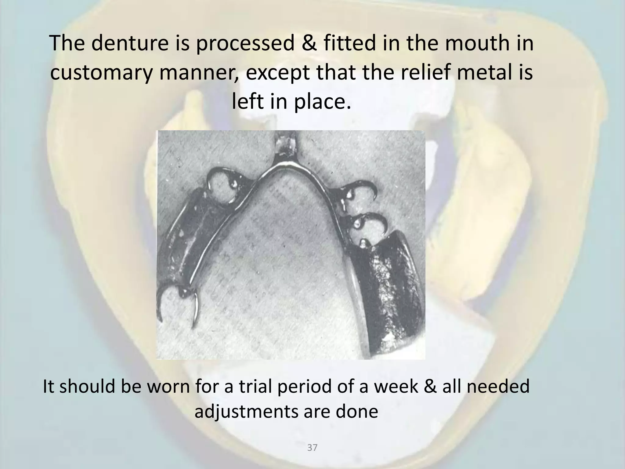 Altered casts technique | PPTX