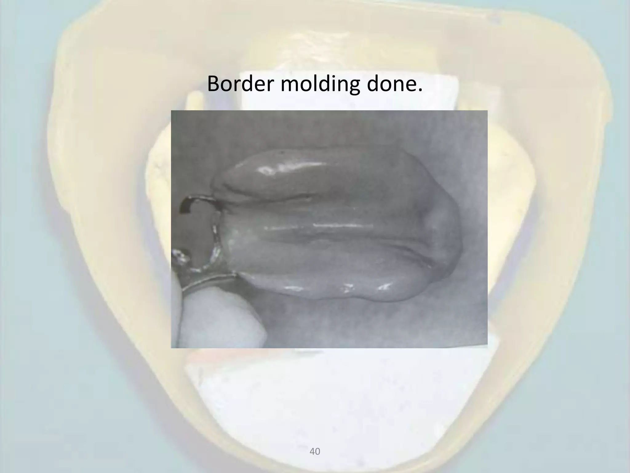 Altered casts technique | PPTX