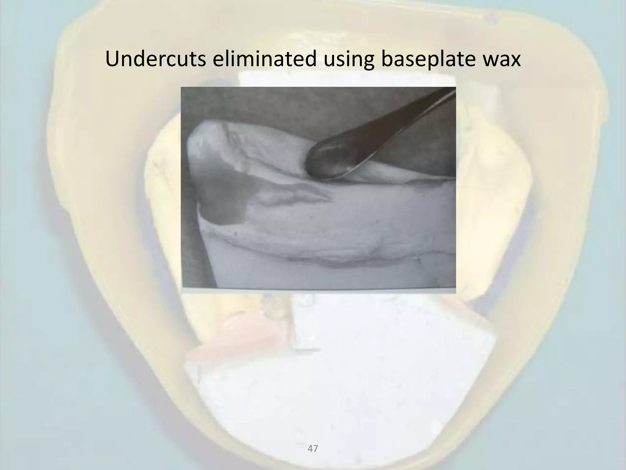 Altered casts technique | PPTX