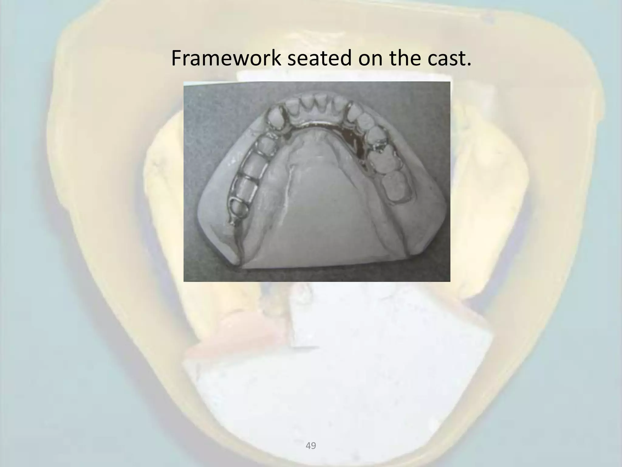 Altered casts technique | PPTX