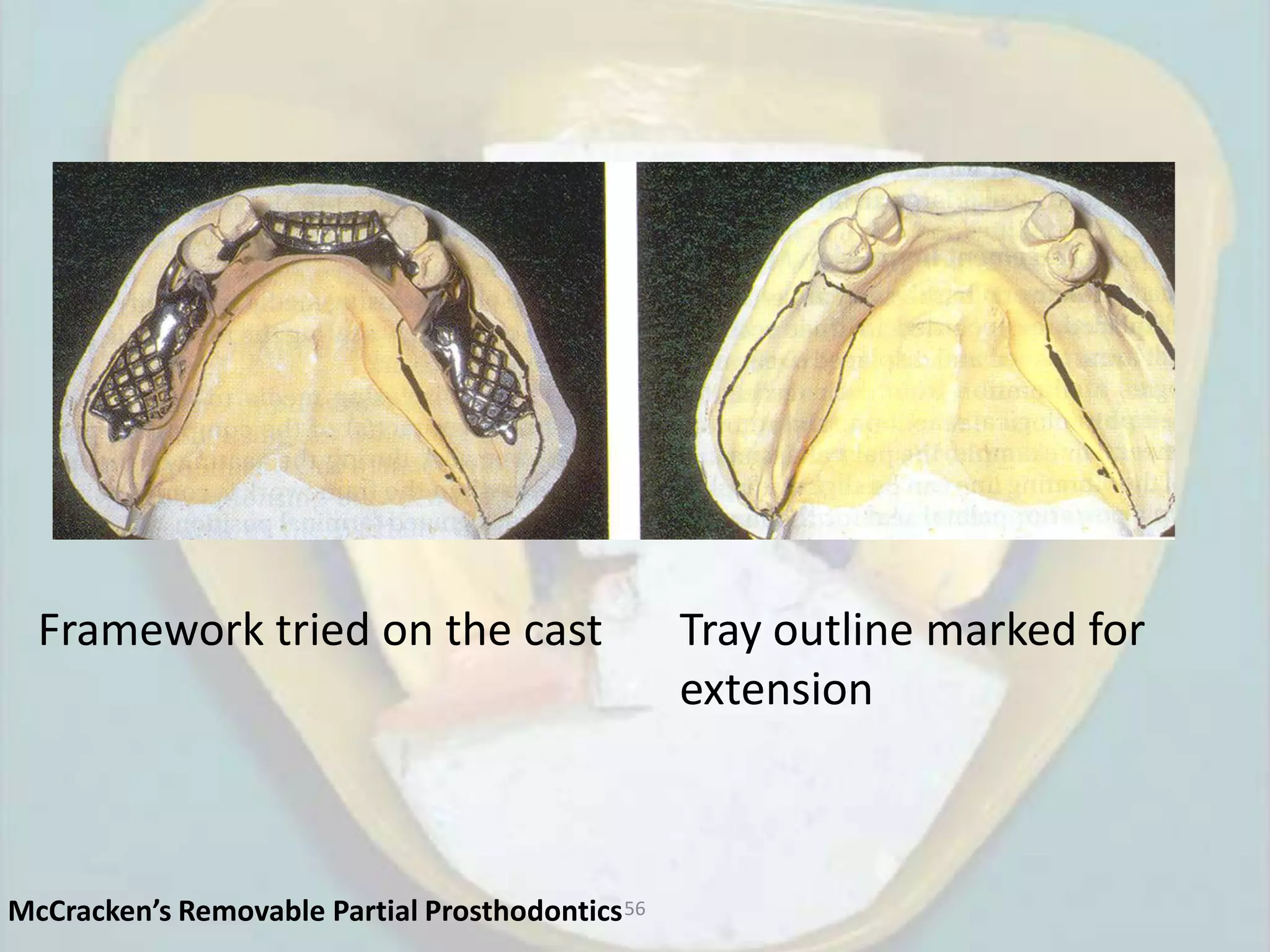 Altered casts technique | PPTX