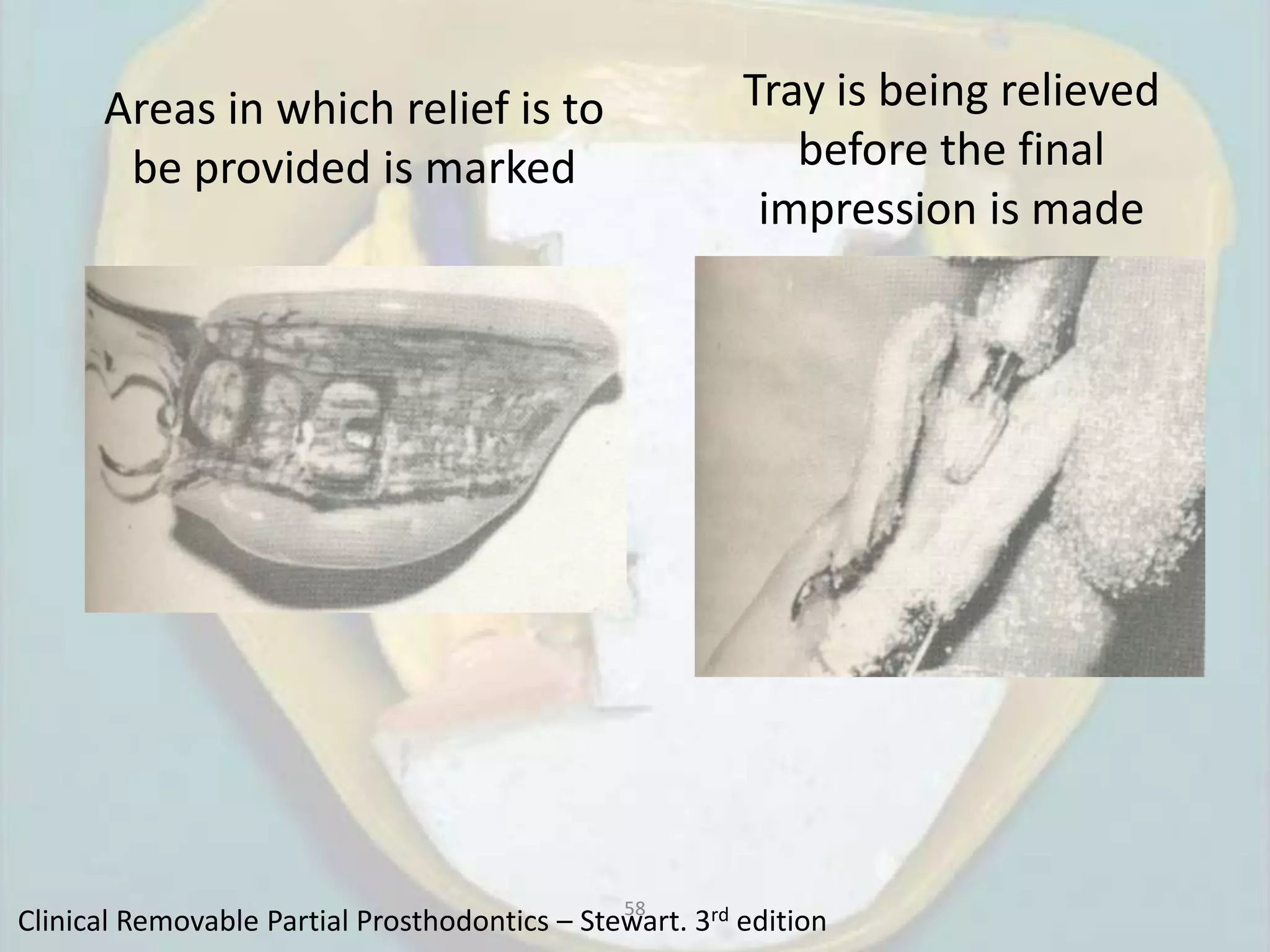 Altered casts technique | PPTX