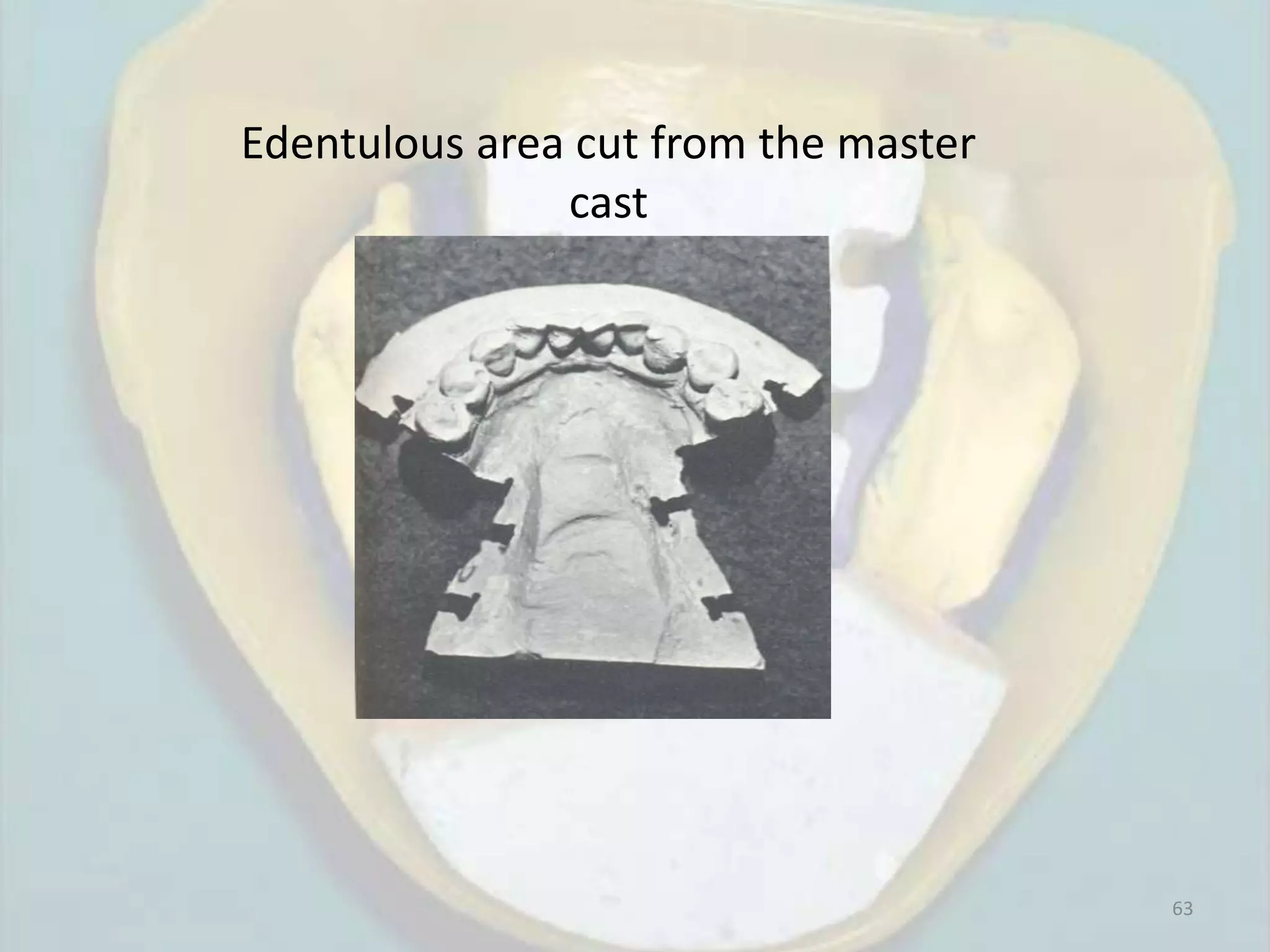 Altered casts technique | PPTX