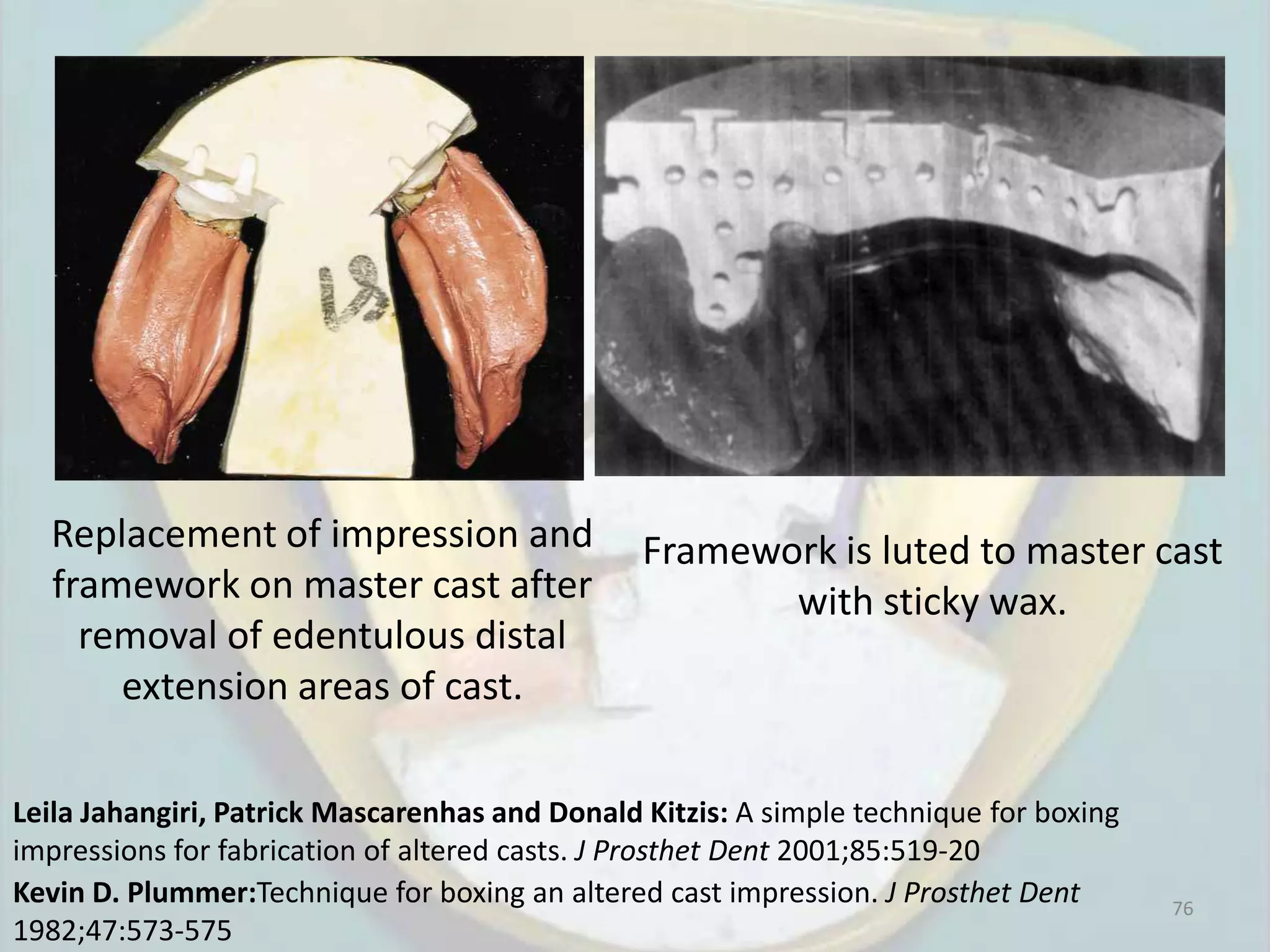 Altered casts technique | PPTX