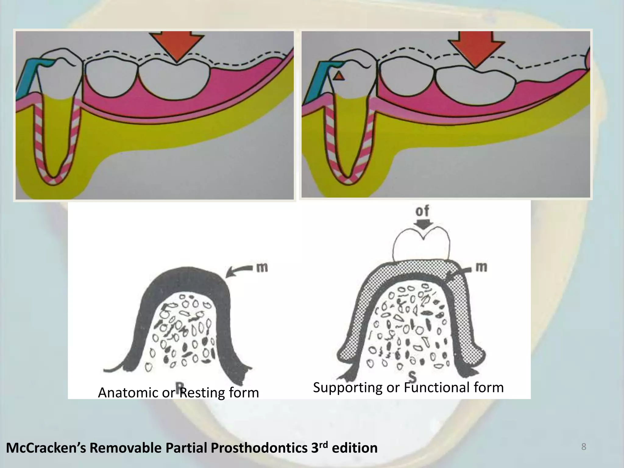 Altered casts technique | PPTX