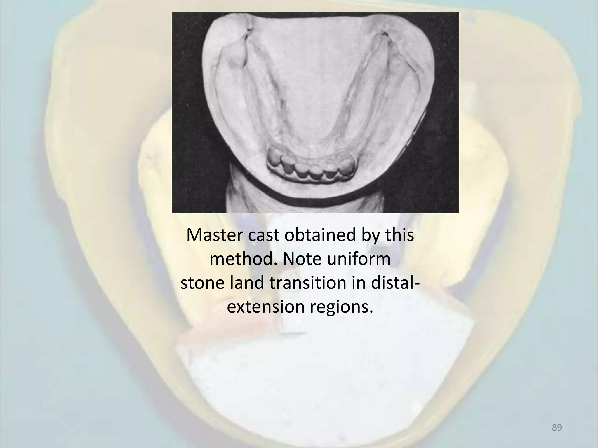 Altered casts technique | PPTX