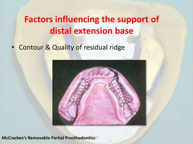 Altered casts technique | PPTX