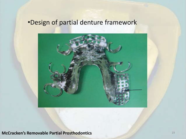 Altered casts technique | PPTX