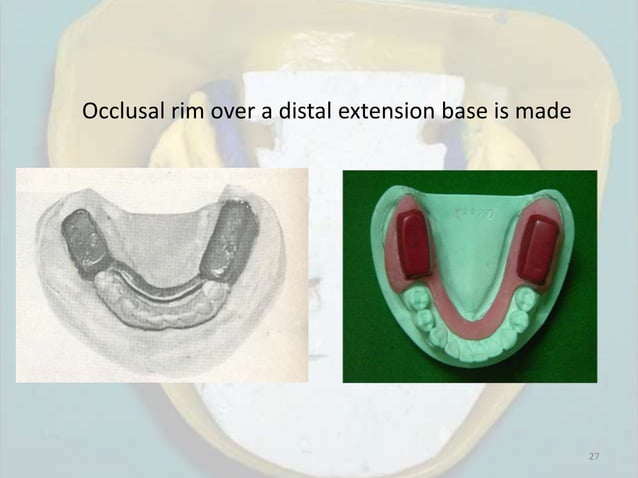 Altered casts technique | PPTX