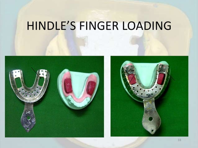 Altered casts technique | PPTX