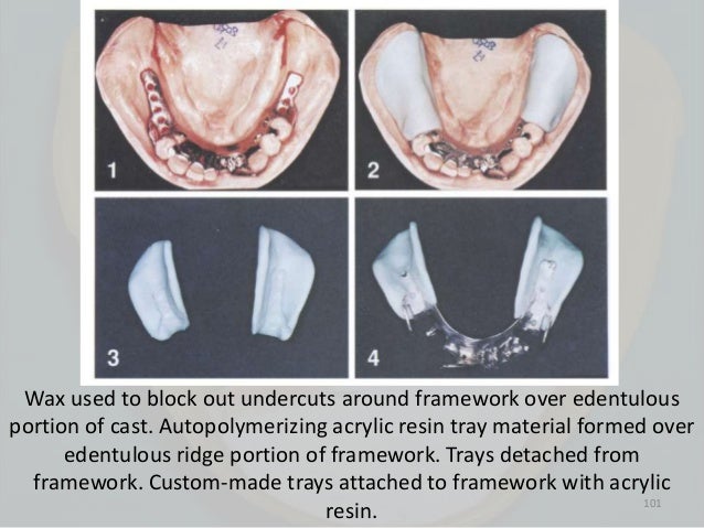 Altered casts technique