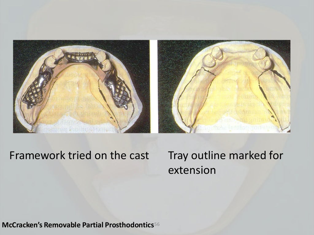 Altered casts technique