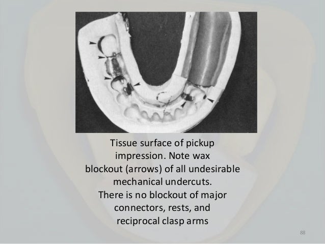 Altered casts technique