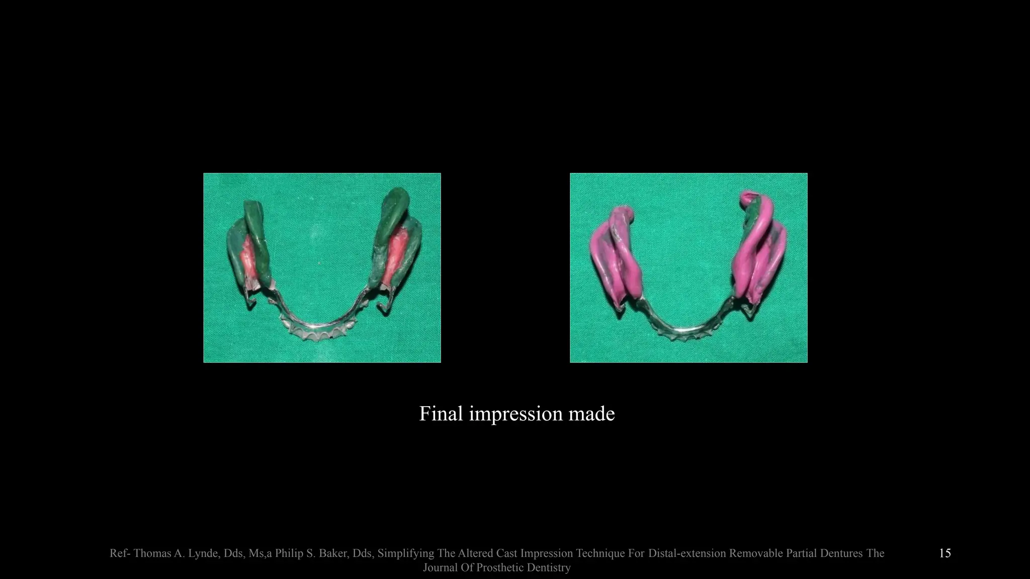 Altered Cast Technique removable partial denture 3.1.pptx