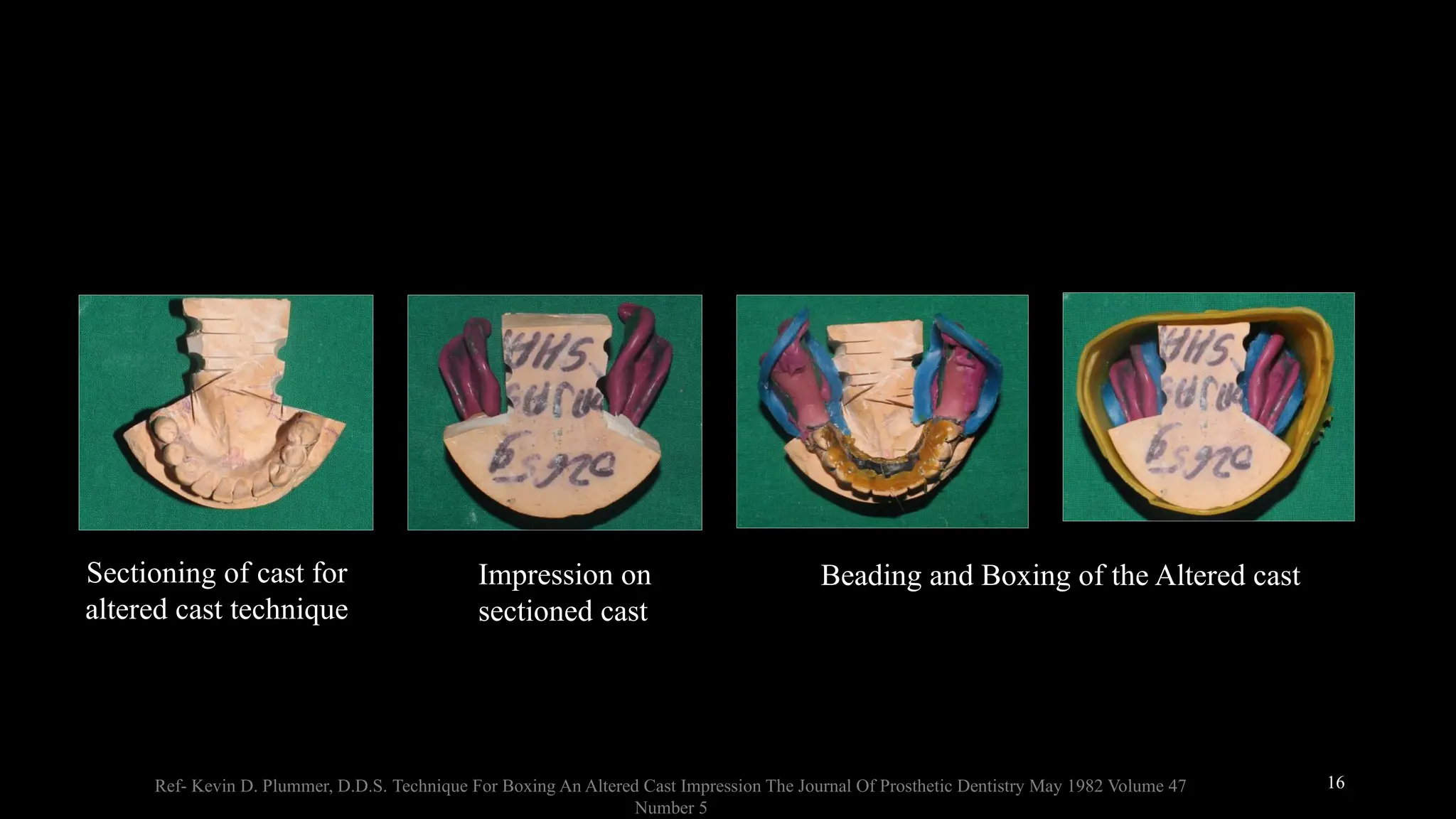Altered Cast Technique removable partial denture 3.1.pptx