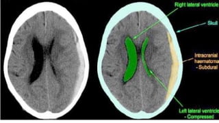 ALTERED SENSORIUM AND COMA Consciousness | PPTX
