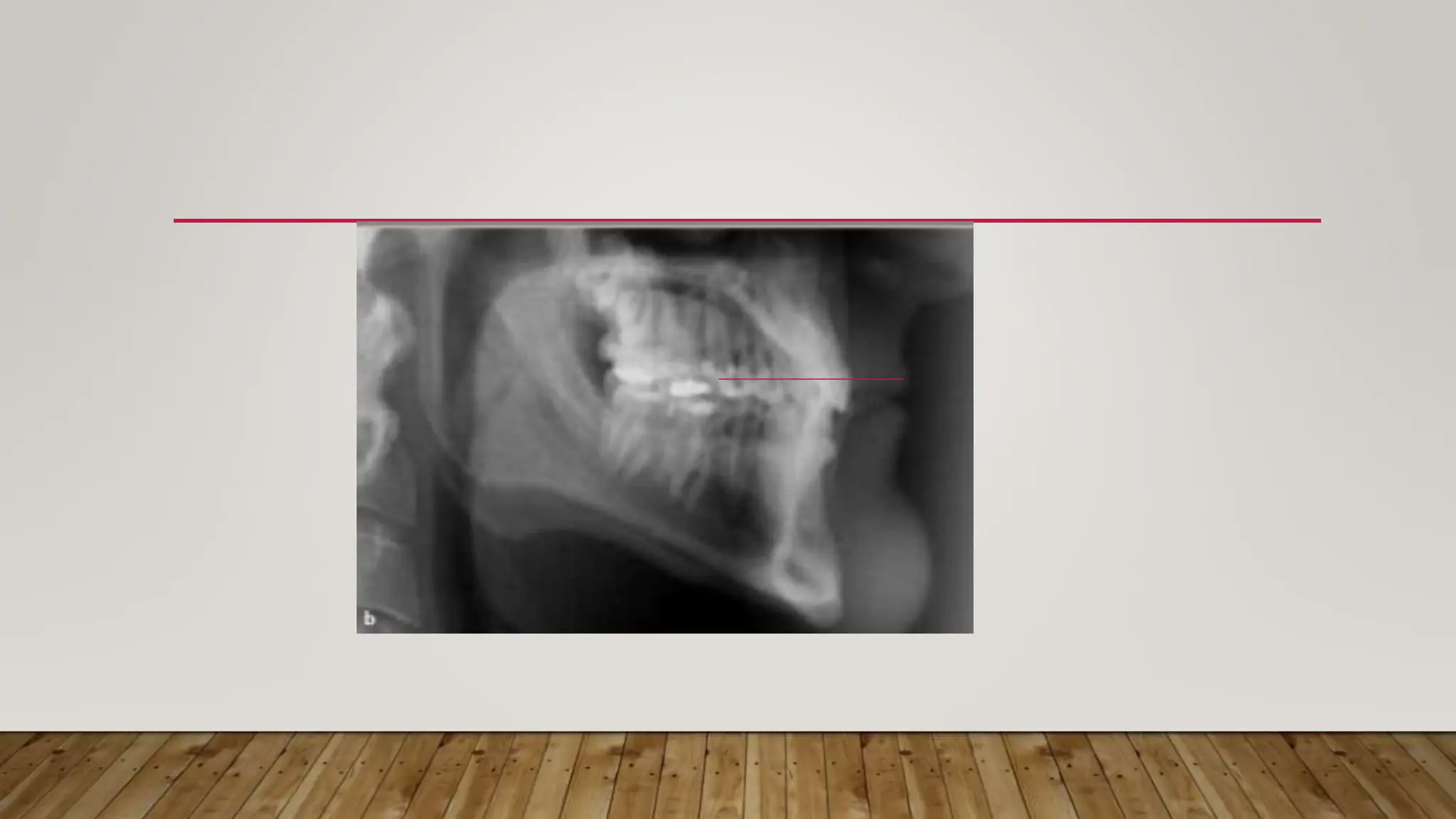 Altering vertical dimension of occlusion.pptx
