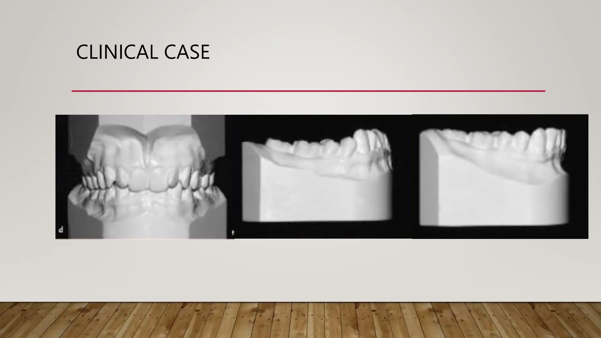 Altering vertical dimension of occlusion.pptx