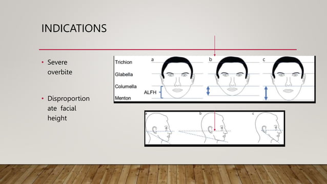 Altering vertical dimension of occlusion.pptx