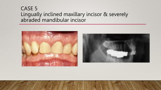 Altering vertical dimension of occlusion.pptx