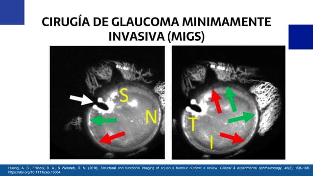 ALTERNATIVAS DE MANEJO EN EL GLAUCOMA PRIMARIO DE ANGULO ABIERTO .pptx