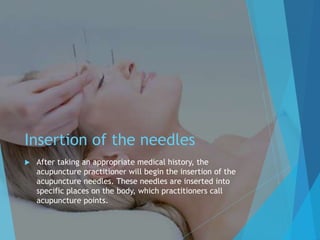 Acupuncture | PPTX