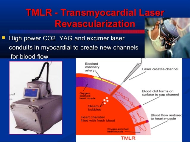 Transmyocardial Revascularization