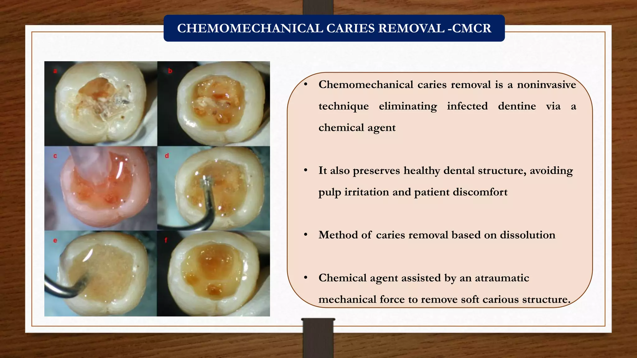 Alternative methods of caries removal (1) | PPTX