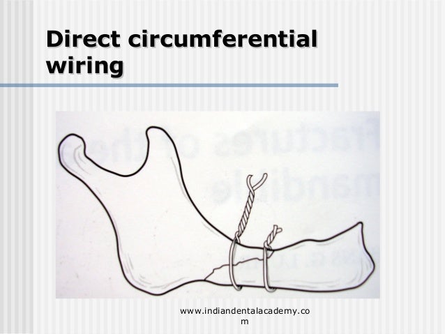 Alternative methods of fixation /dental courses