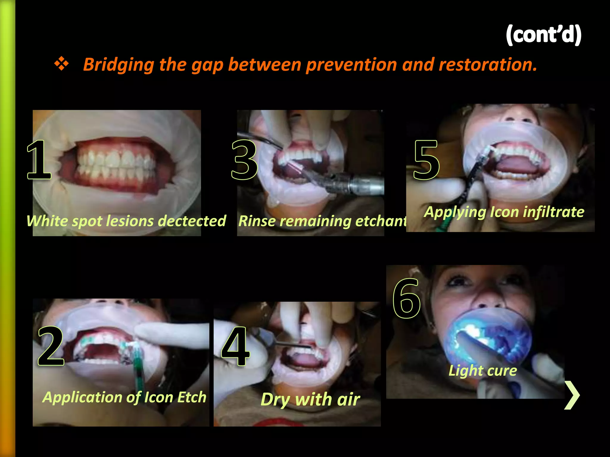 Alternatives to conventional cavity preparation in paedodontics | PPTX