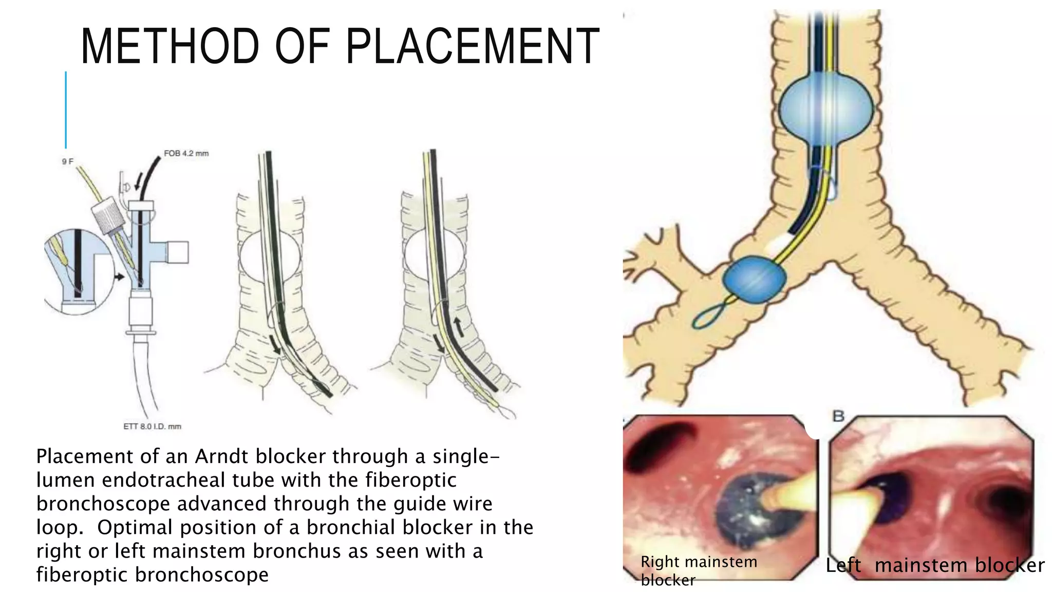 ALTERNATIVES TO double lumen tubes IN ONE LUNG VENTILATION.pptx