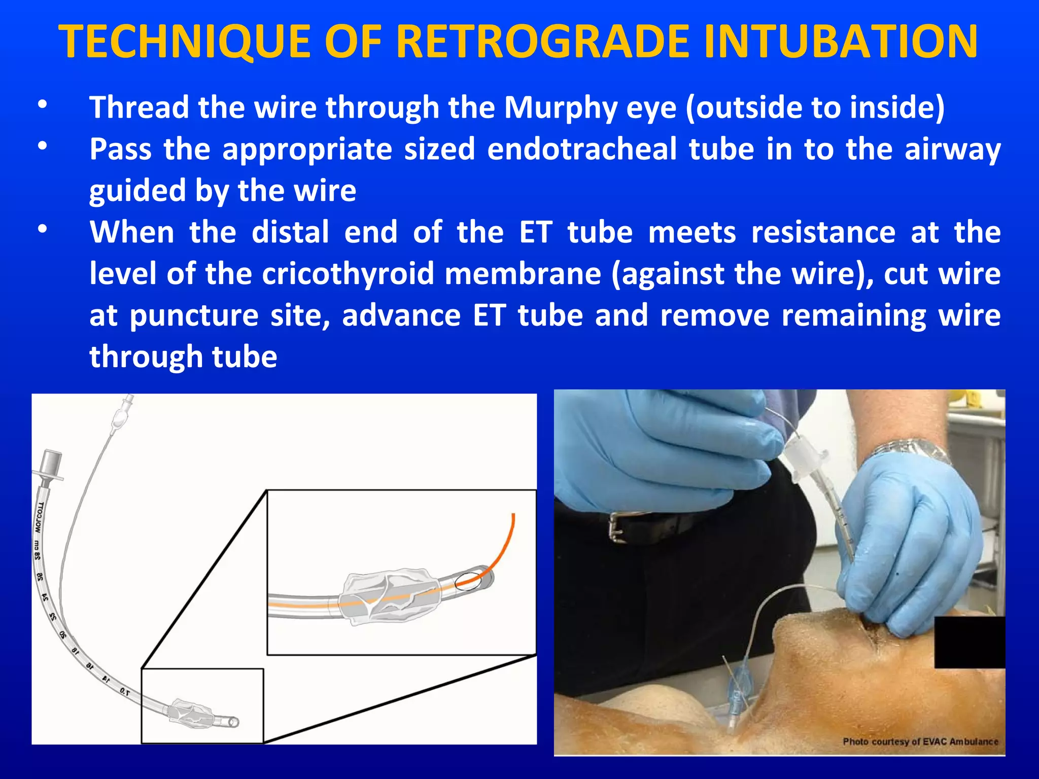 Alternative technique of intubation retromolar, retrograde, submental ...