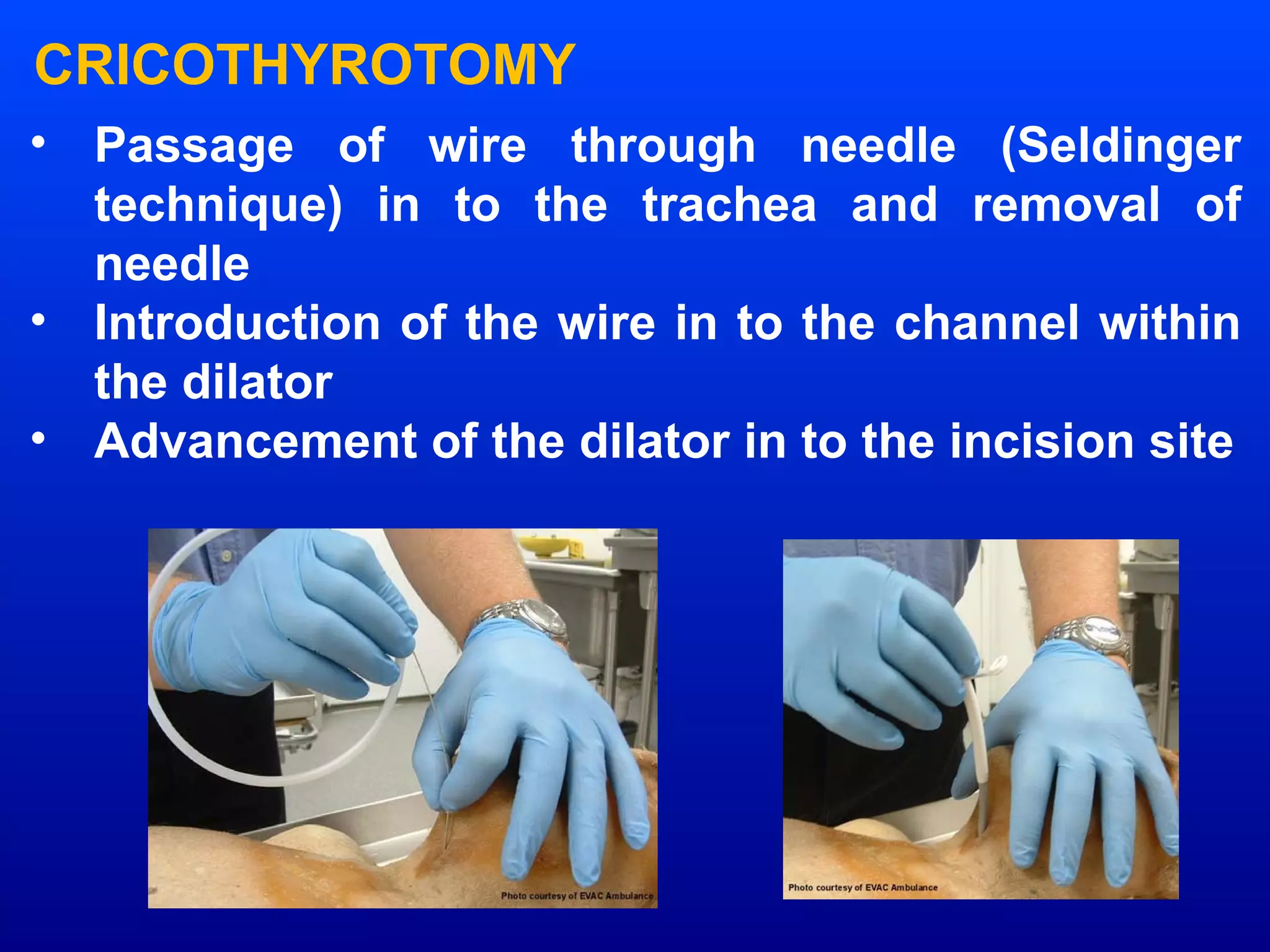 Alternative technique of intubation retromolar, retrograde, submental ...