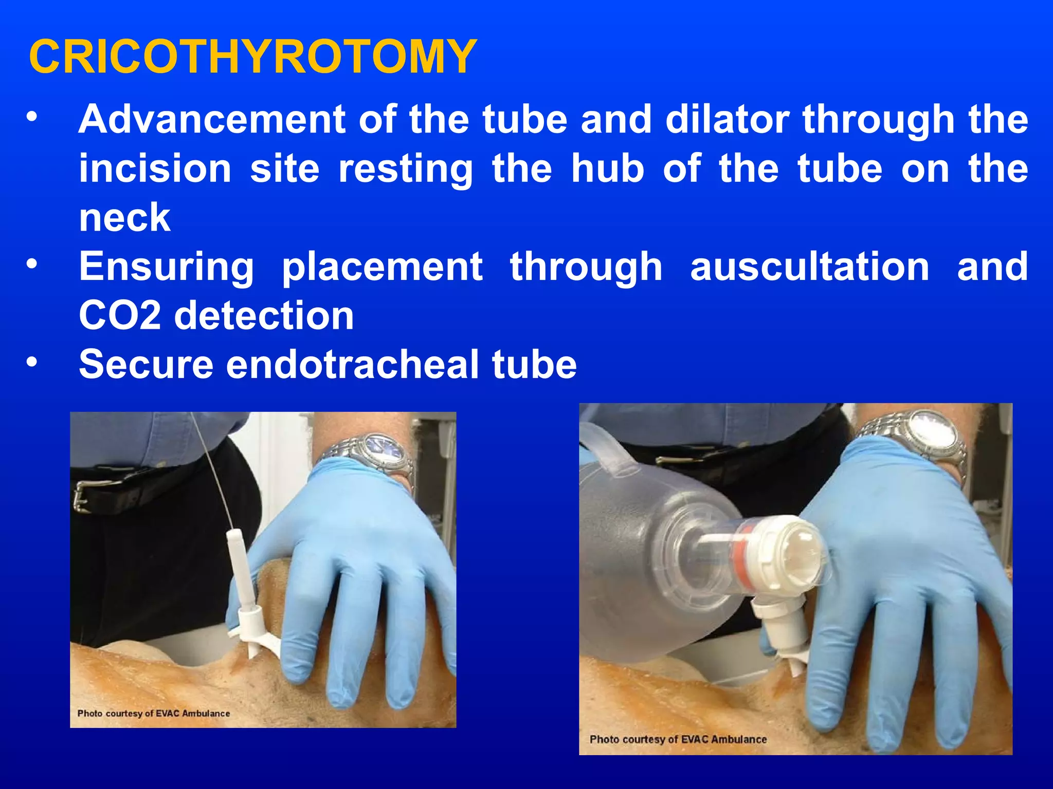Alternative technique of intubation retromolar, retrograde, submental ...