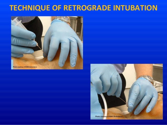 Alternative technique of intubation retromolar, retrograde, submental…