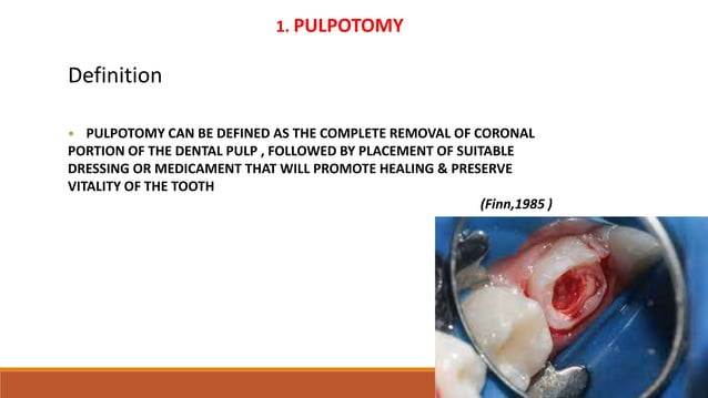 Alternative Root Canal Therapy | PPT